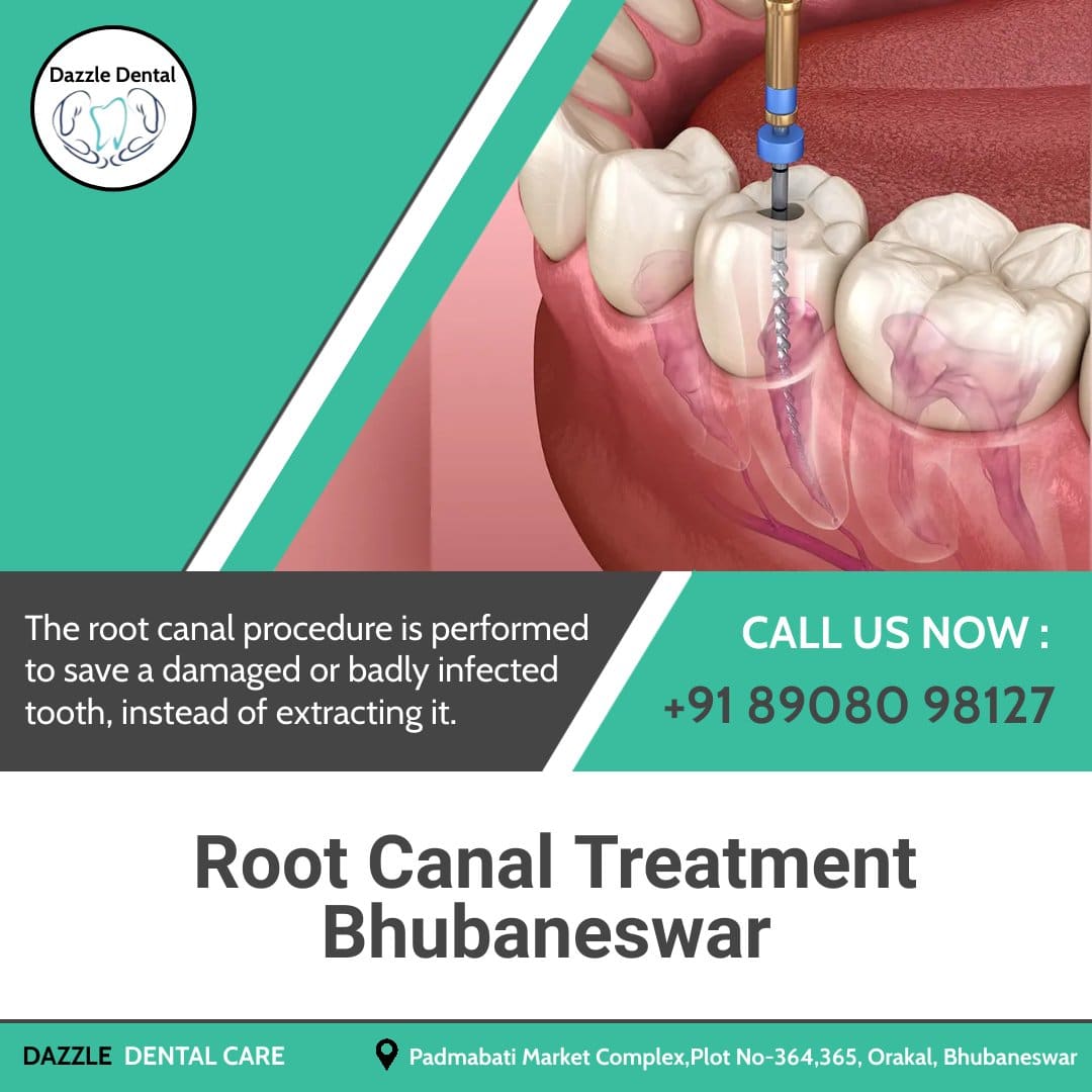 Root Canal Treatment Sundarpada Bhubaneswar - AD-BY-U